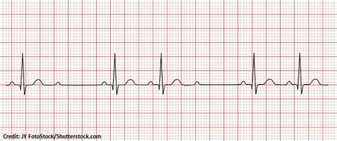Second Degree Type II AV Heart Block Mobitz II ECG Review