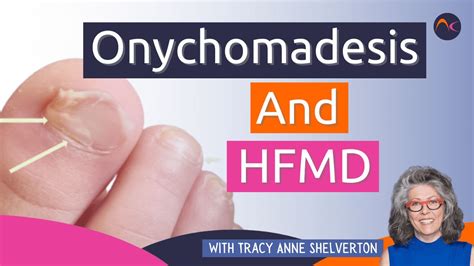 Onychomadesis And Hand Foot And Mouth Disease Nailknowledge