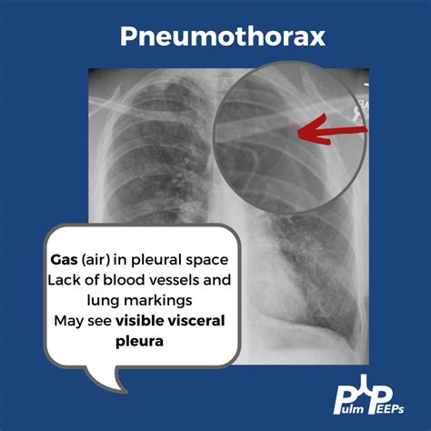 Spontaneous Pneumothorax