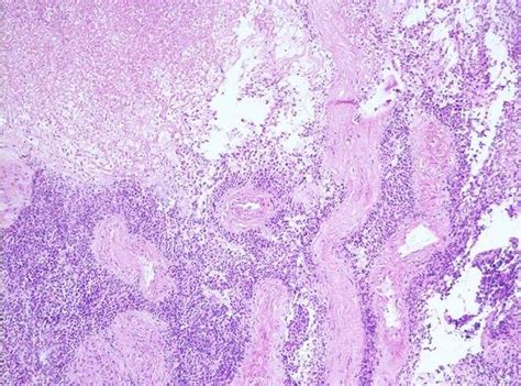 Biopsy Showing Malignant Round Tumor Cells And Geographic Areas Of
