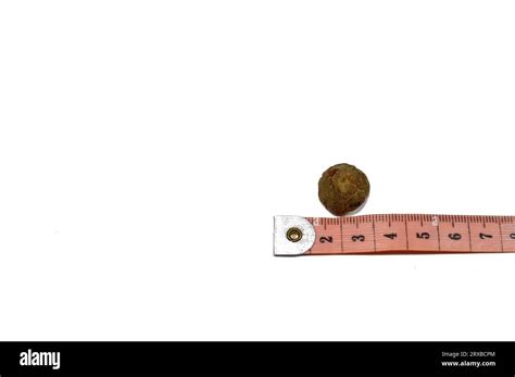 Calcoli Biliari Grandi Rimossi Chirurgicamente Dopo Colecistectomia