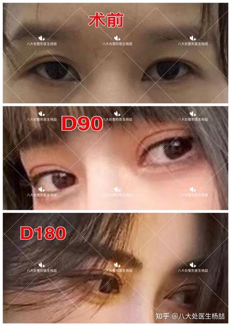 双眼皮修复案例分享 知乎