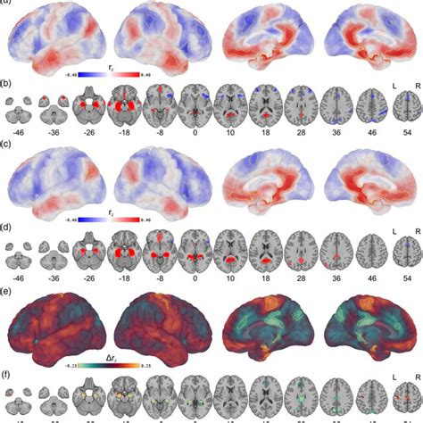 Anterior And Posterior Hippocampus Showed Moderate Differences In The