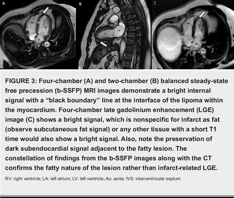 Figure 3 From An Intramyocardial Lipoma Mimicking Post Infarction Fatty