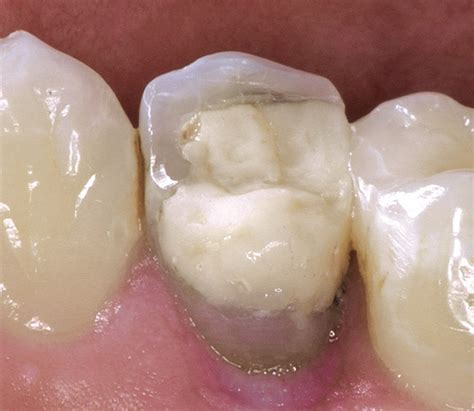 A Dual Cure Composite Core For Teeth To Be Restored With Full Crowns