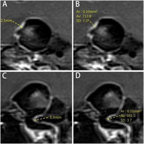 Enhancing Intracranial Aneurysm Rupture Risk Prediction With A Novel