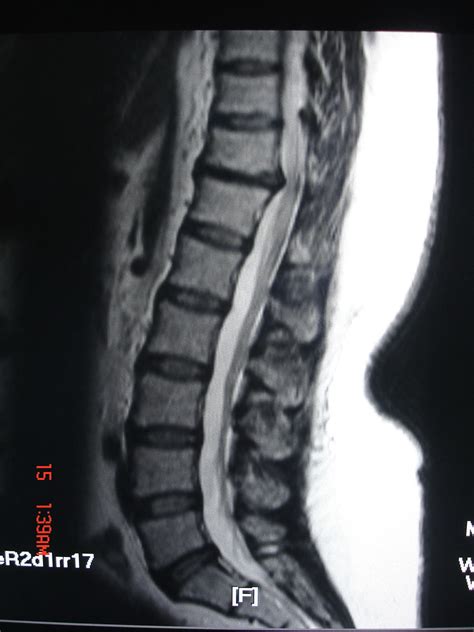 Spine D11 D12 Disc Herniation And D10 D11 Facet Enlargement Radioogle