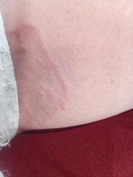 Diagnose My Rash Photo Please Mumsnet