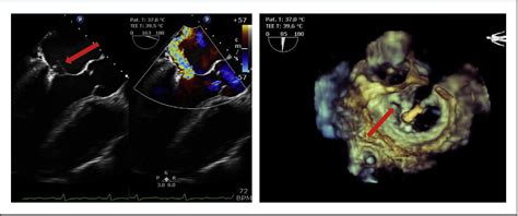 Figure 4 From Percutaneous Repair Of Mitral Valve Leaflet Perforation