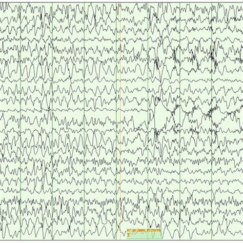 Continuous Electroencephalographic EEG Monitoring Is An Effective Download Scientific Diagram
