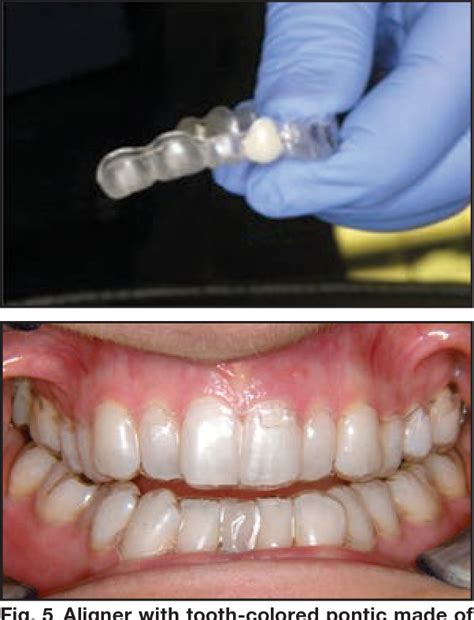 Figure 5 From Invisalign Treatment Of Class Iii Malocclusion With Lower