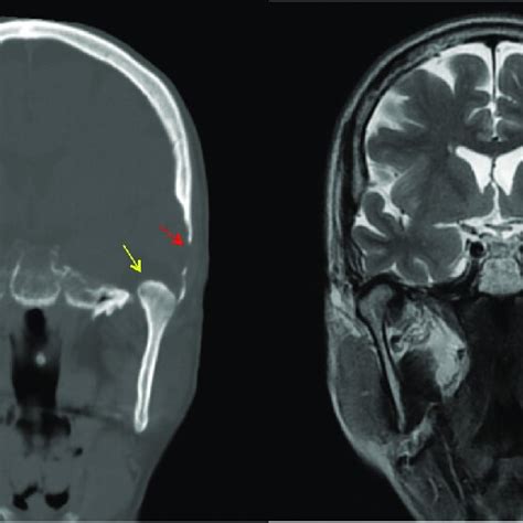 Left Ct Indicates A Left Condylar Dislocation And Absence Of The