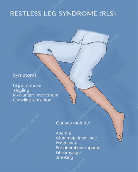 What Mineral Deficiency Causes Restless Leg Syndrome At Tommy Lotts Blog