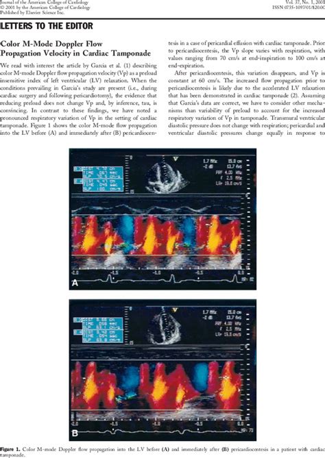 Color M Mode Doppler Flow Propagation Velocity In Cardiac Tamponade