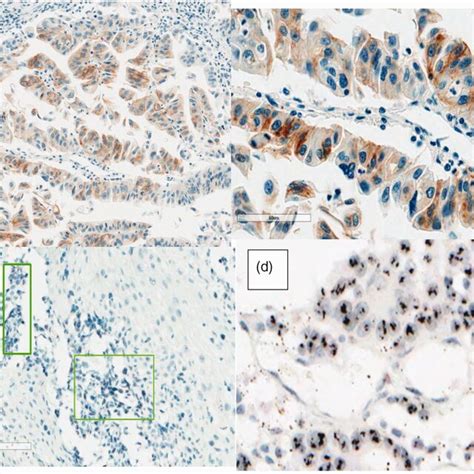 Human Epidermal Growth Factor 2 Her2 Positive Gastric Carcinoma By