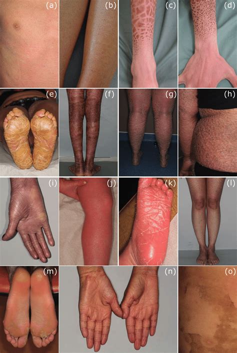 Examples Of Skin Signs In Non Syndromic Ichthyoses A B Fine