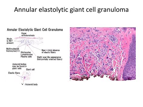Granuloma Annulare 20 Ppt