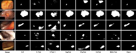 Qualitative Comparisons In Polyp Segmentation In Which The First To
