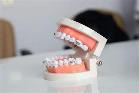 How Long Do Braces Take What To Expect When Getting Them