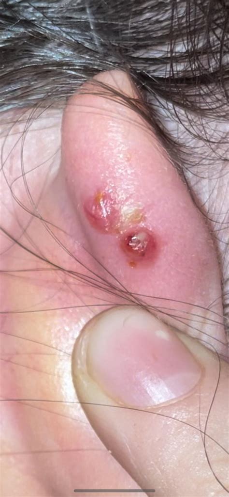 Infected Piercing I Took It Out Rpiercingadvice