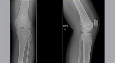 radiographic examination demonstrating bone lesion in the distal femur