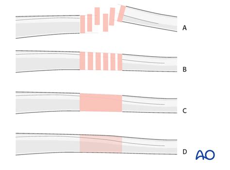 Orif Plate Fixation Distal 1 3 For Multifragmentary Fracture Intact Segment