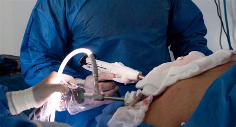 Appendix Removal Laparoscopic Abdominoplasty