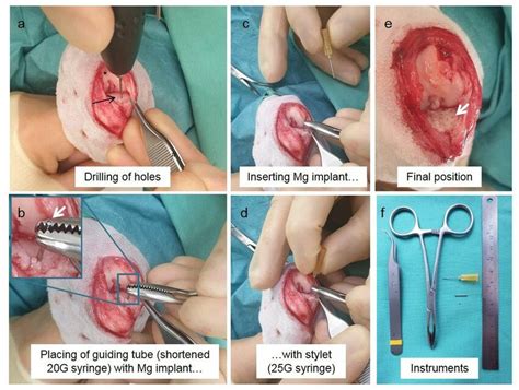 Surgical Procedure A Placement Of Drilling Holes Drilling Group And