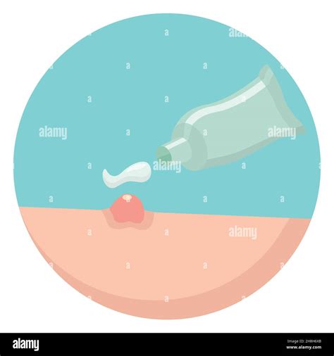 Acne And Breakout Solution Applying Cream From Tube On Pimple For Topics Like Skincare