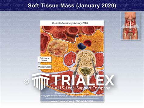 Soft Tissue Mass Trialquest Inc