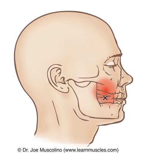 Buccinator Trigger Points Learn Muscles