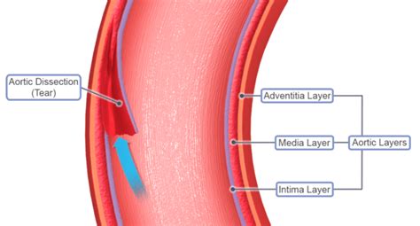 1 Formation Of An Intimal Tear And Consequently Of An Aortic