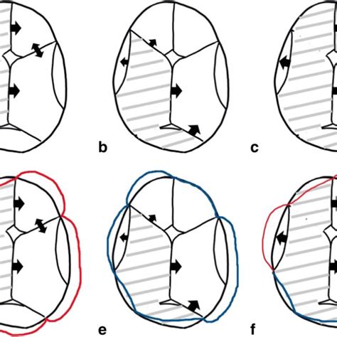 213 Cloverleaf Skull Deformity Download Scientific Diagram
