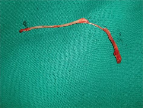 Peripheral Neurectomies A Treatment Option For Trigeminal Neuralgia In Rural Practice Journal