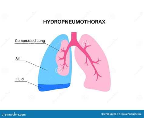 Hydropneumothorax Medical Poster Vector Illustration 275862812