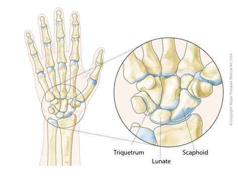 Proximal Row Carpectomy Grip Hand And Wrist Surgery