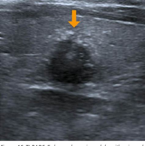 [pdf] Ti Rads Classification Of Thyroid Nodules Based On A Score Modified According To