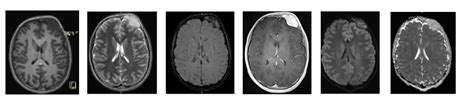 Hiperostosis frontal interna Buscador médico