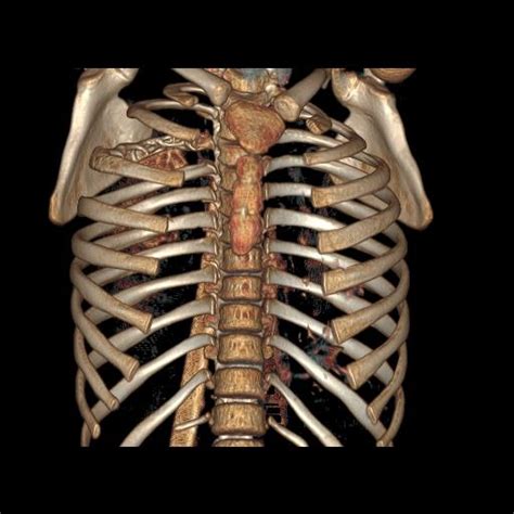 Ewing Sarcoma Of Rib Pacs