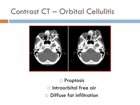 Ppt Periorbital Vs Orbital Cellulitis Powerpoint Presentation Free
