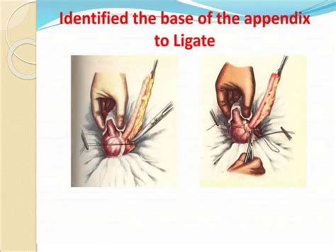 Appendicitis Clinical Sign Symptoms And Management Ppt