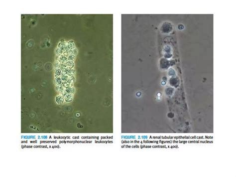 Urine Microscopy Ppt