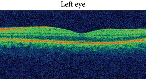 Al Serial Oct Scans Showing The Evolution Of Maculopathy Obtained