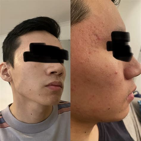 Acne My Fungal Acne Malassezia Skincare Routine Rskincareaddiction