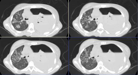 Cxr 胸部x光判讀 Tuberculosis