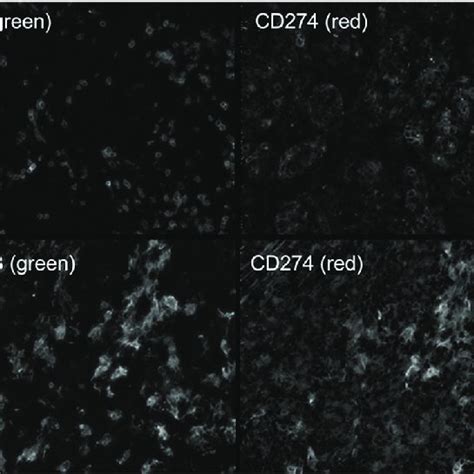 Colocalization Of Cd274 With Immune And Tumor Cell Markers By