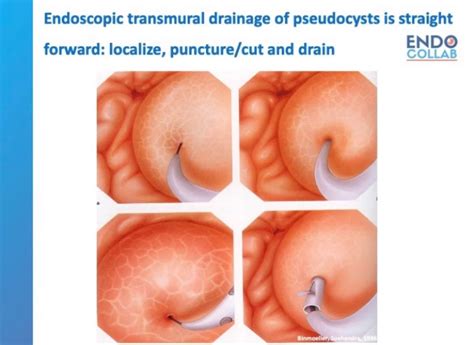 Klaus Mönkemüller On Linkedin 🔥 Pseudocyst Drainage Made Easy 🚀 🎯 4
