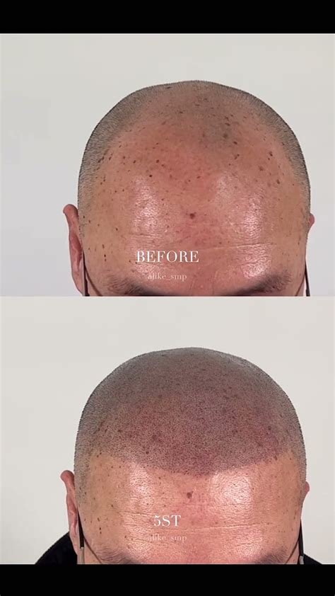 삭발문신 탈모 탈모문신 두피문신 대머리문신 민머리문신 탈모커버 탈모커버문신 두피문신 두피문신후기 삭발 Youtube