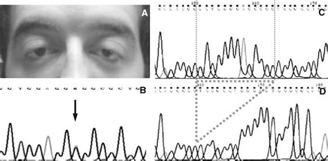 Ad Clinical And Molecular Findings In Patient 3 A Patient Presents