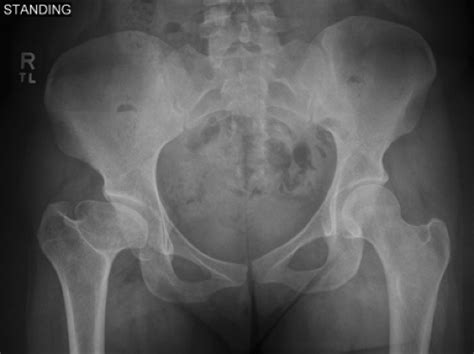 The Symptomatic Residual Slipped Capital Femoral Epiphysis And Legg